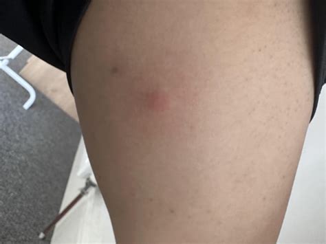 Help Scabies R Scabies