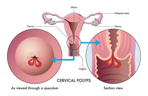 Cervical Polyps