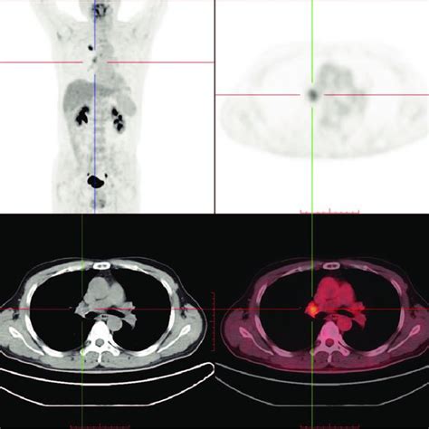 The Contrast Of Mediastinal Lymph Nodes Metastasis In Lung Cancer