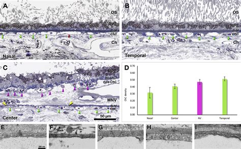 Nonexudative Macular Neovascularization Supporting Outer Retina In Age Related Macular