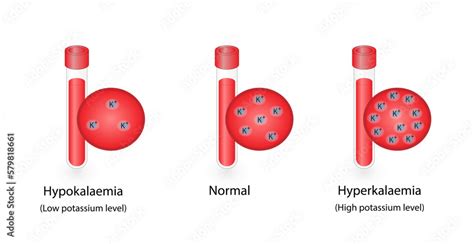 Vetor De Hyperkalaemia High Plasma Potassium Level And Hypokalaemia Low Plasma Potassium Level