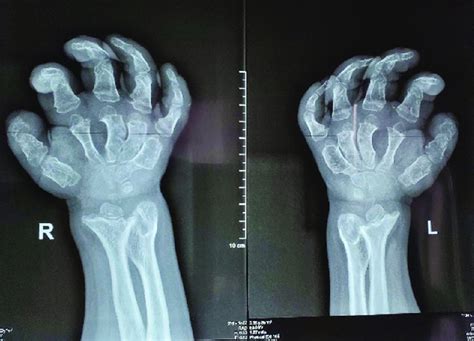 Bullet Shaped Phalanges With Proximal Pointing Of All Metacarpals Download Scientific Diagram Bullet Shaped Phalanges With Proximal Pointing Of All Metacarpals Download Scientific Diagram