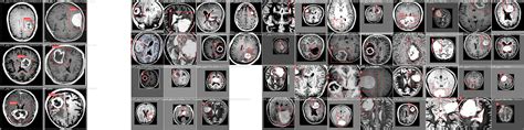 Brain Tumor Detection Yolov8 Vs Sam 2 By Pascal Musa Medium