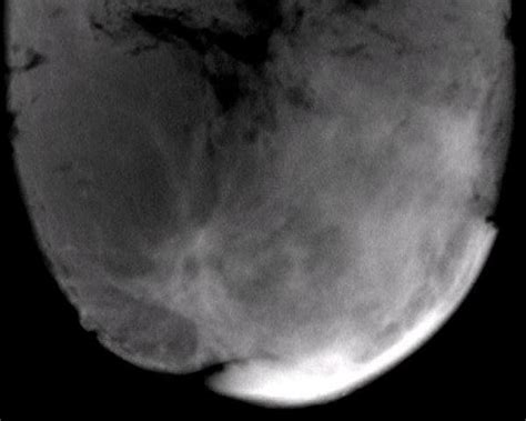 Simulated Mammogram The Area Might Contain Micro Calcification Is