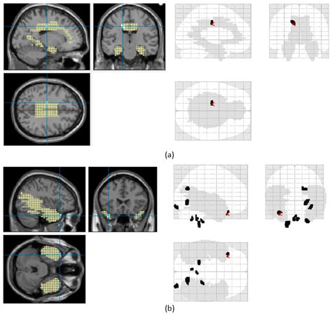 Temporal Lobe Epilepsy Focus Detection Based On The Correlation Between