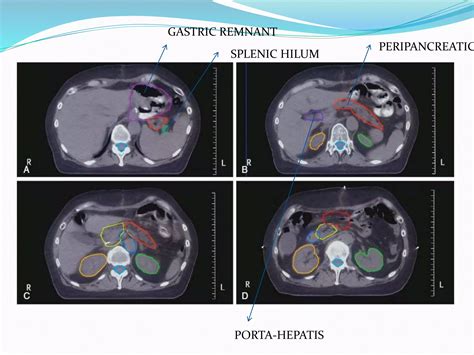 Staging And Management Of Ca Stomach Pptx