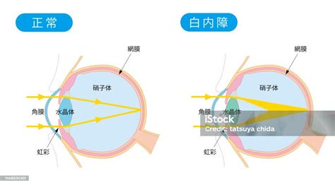 Cross Section Of A Normal Eye And A Cataract Eye Stock Illustration