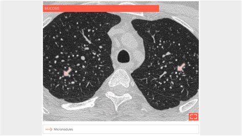 Traction Bronchiectasis Bronchiolectas Imaging Atlas