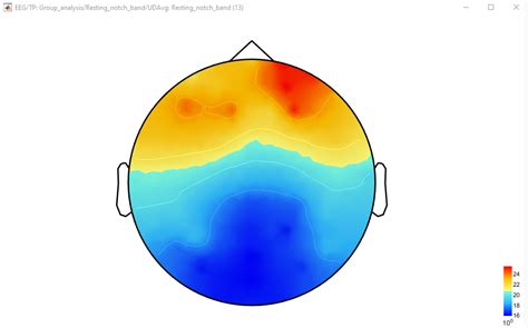 Resting State Eeg Alpha Band Activity With Eyes Closed Brainstorm