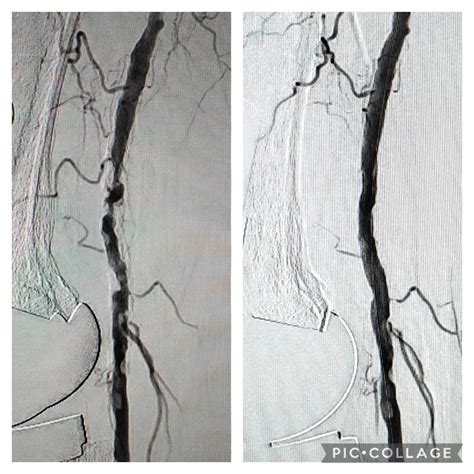 Lorenzo Patrone On Linkedin Does Shockwave Work In Eccentric Nodular Calcium 🤔 Case Done With