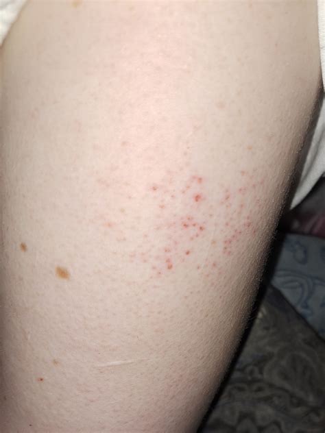 What is this on my arm? : r/DermatologyQuestions