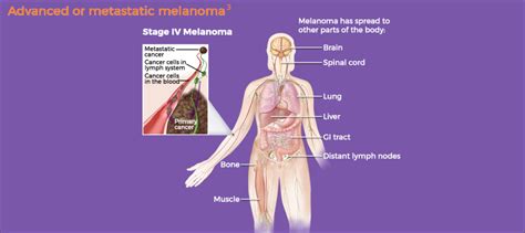 Diagnosis And Symptoms Of Melanoma Activate Melanoma