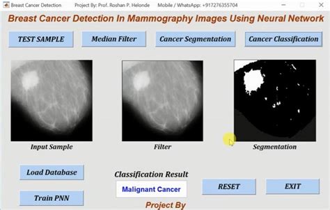 Breast Cancer Detection In Mammography Images Using Neural Network Matlab Project IEEE Based