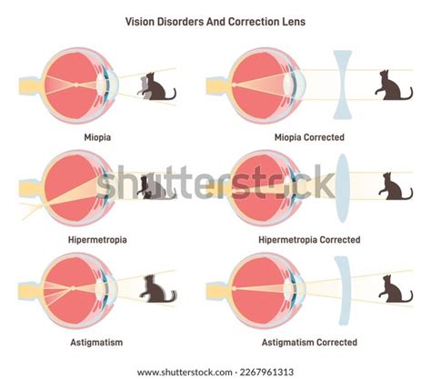 Myopia Hyperopia Astigmatism Common Vision Disorders Stock Vector