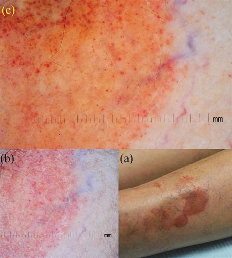 Figure 2 From Does Dermatoscopy Facilitate The Detection And Diagnosis