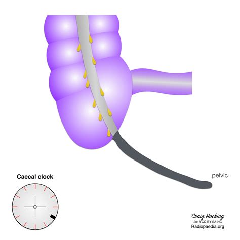 Radiopaedia Drawing Pelvic Appendix Position English Labels AnatomyTOOL