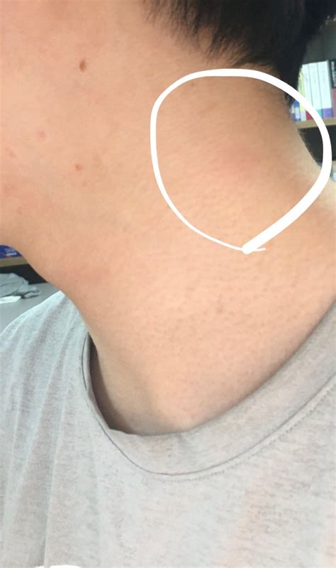 목 옆에 혹 같은게 생겼어요 지식in
