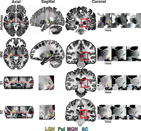 Anatomical Localization Of Human Subcortical Structures The Anatomical Download Scientific