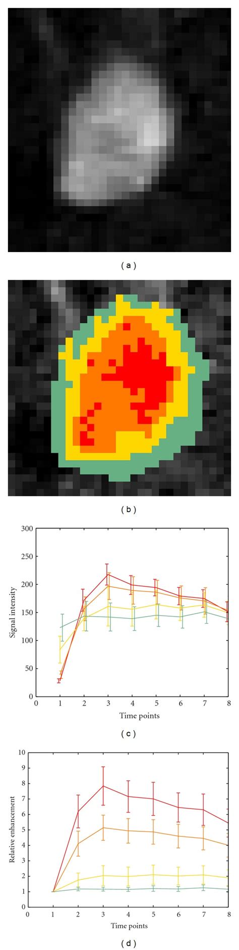 Dce Mri Image A And Overlaid Lesion Clustering B Comparison Download Scientific Diagram