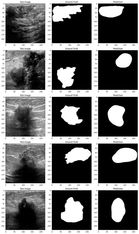 Efficientunetvit Efficient Breast Tumor Segmentation Utilizing Unet Architecture And Pretrained
