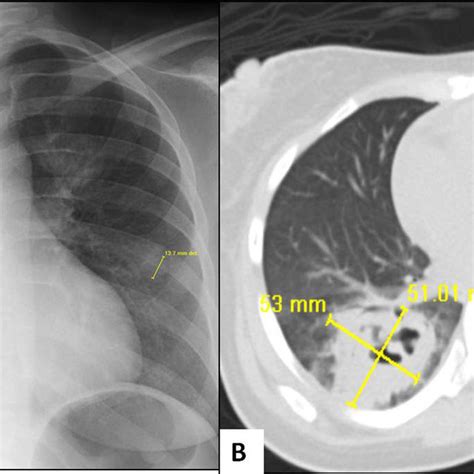 Pdf A Case Of Ulcerative Colitis Presenting As Pyoderma Gangrenosum