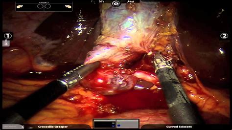 Da Vinci Single Site Cholecystectomy With Intraoperative Cholangiogram