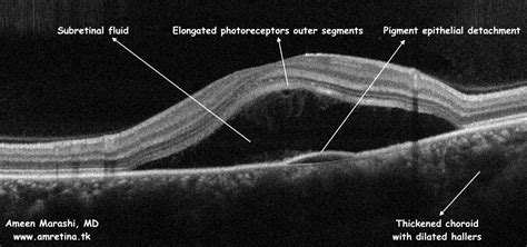 Acute Central Serous Chorioretinopathy Fundus Image Oct And Ffa In A