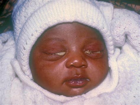 Gonorrhea Prevention And Treatment Facts To Know Step To Health