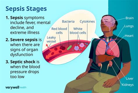 Sepsis Signs And Symptoms Does Your Receptionist Recognise Signs Of