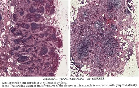 Pathology Outlines Vascular Transformation Of Sinuses
