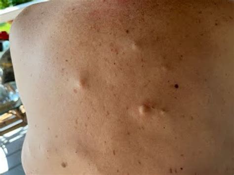 EXTREME CYST PIMPLE EXPLOSION UNDER PRESSURE YouTube