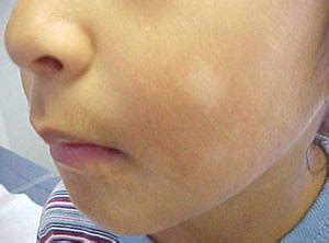 Pitiriase Alba Em Adultos Pityriasis Alba Condition Treatments And