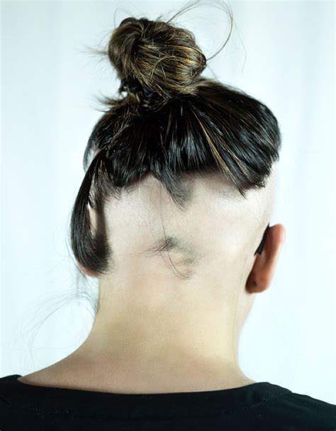 Ophiasis Alopecia Causes Symptoms And Treatments
