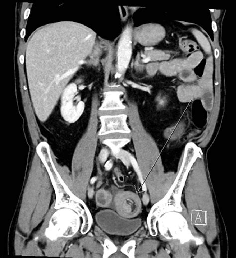 Abdominal Ct Scan Ileo Ileal Intussusception With A Target Sign Arrow