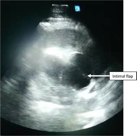 Visualisation Of The Intimal Flap At The Aortic Root In Tte Download