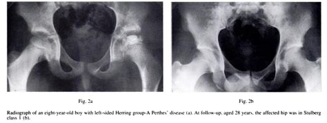 Legg Calve Perthes Disease