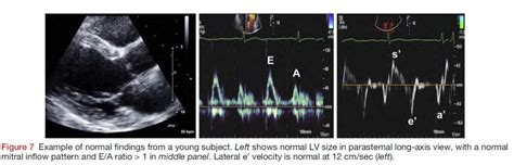 New Recommendations For The Evaluation Of Left Ventricular Diastolic Function By
