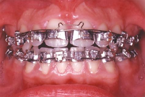 Fully Banded Braces From The Early Eighties Dental Braces