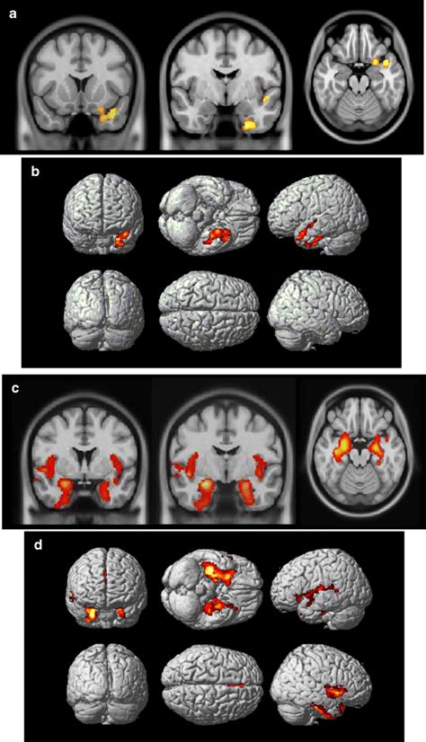 Voxel Based Morphometry Analysis Of Gray Matter Atrophy In Download Scientific Diagram