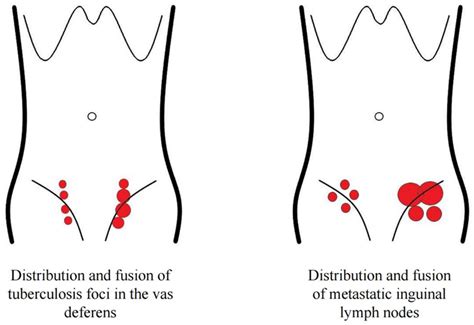 Inguinal Lymph Nodes