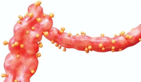 Diverticulitis Diverticular Disease