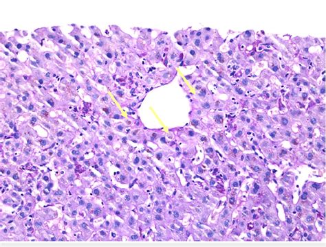 Liver Biopsy Hematoxylin And Eosin 20x The Image Is Showing