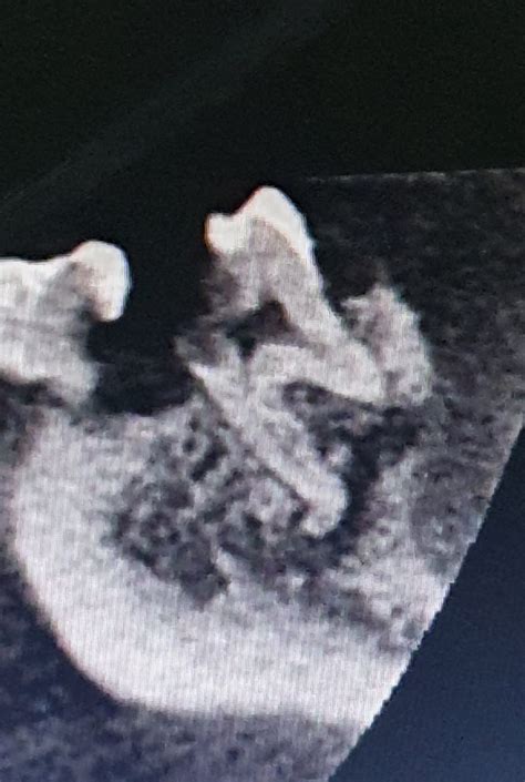 Difficult Wisdom Tooth Removed Easily With Lingual Split Mittal Dental Clinic