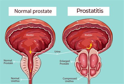 Best Enlarged Prostate Specialist In Glendale La Vascular Specialists