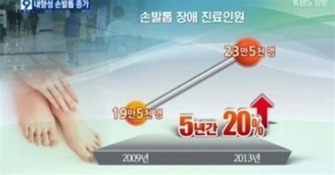 내향성 발톱 치료법 발톱 깍는 방법이 문제 올바른 관리법