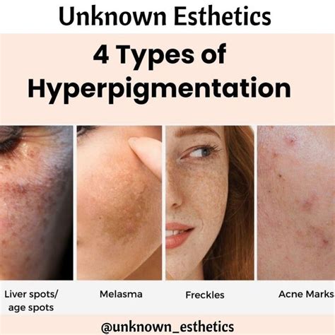 Unknown Esthetics On Instagram Check Out This Informative Post On The 4 Types Of