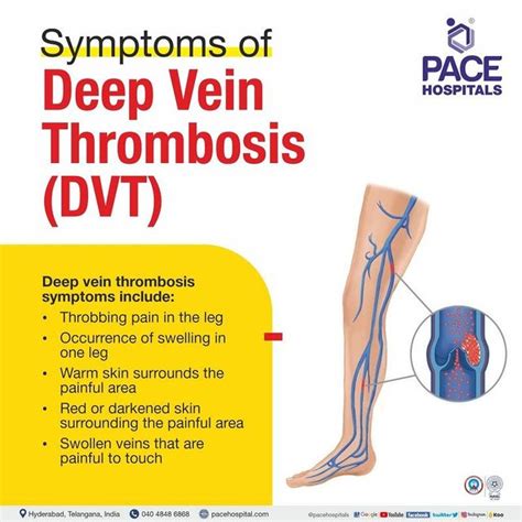 Deep Vein Thrombosis Dvt Symptoms Causes And 59 Off