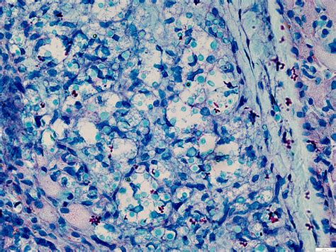 Cryptococcus Cryptococcus