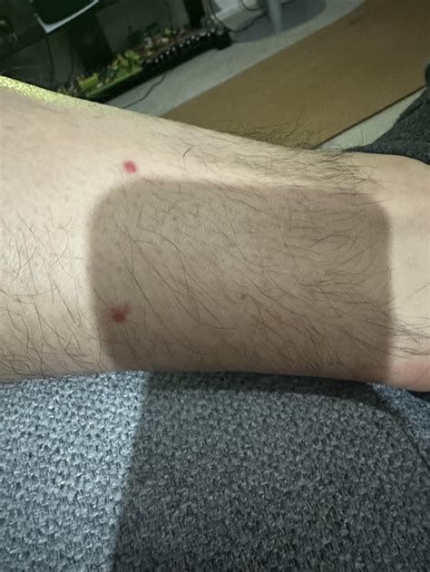 Bug Bite Info Rauckland