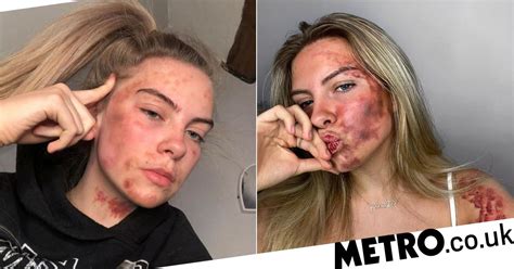 Woman With Skin Condition Embraces Her Look By Going Makeup Free